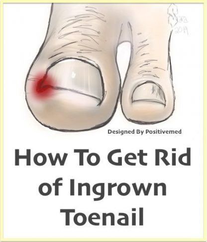 Natural Home Remedy for Ingrown Toenails