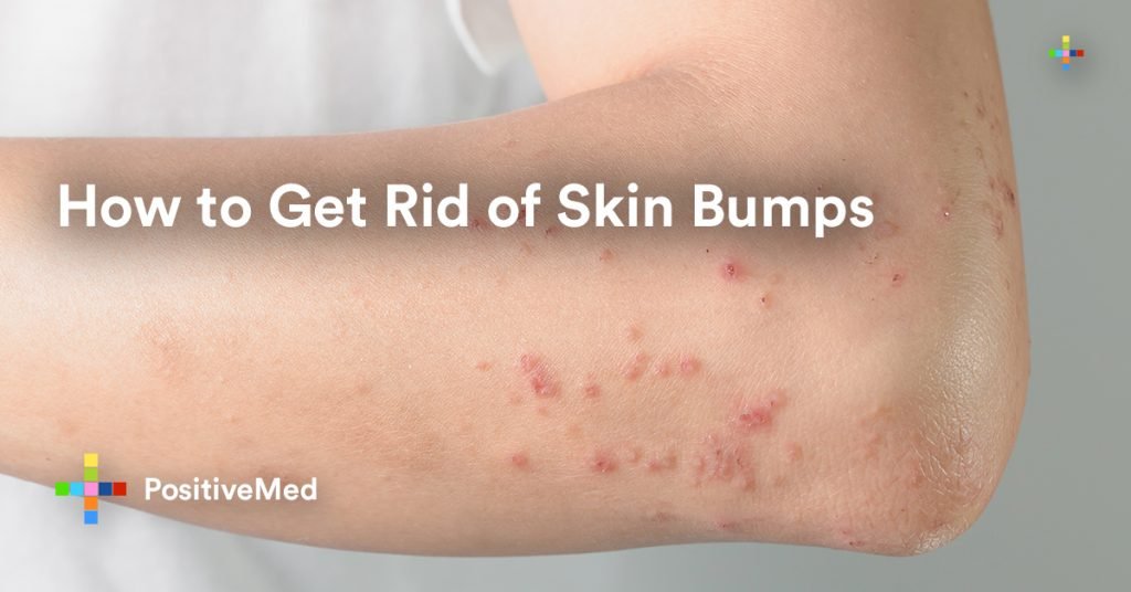How To Get Rid Of Skin Bumps PositiveMed How To Get Rid Of Skin Bumps PositiveMed