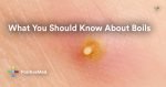 What You Should Know About Boils