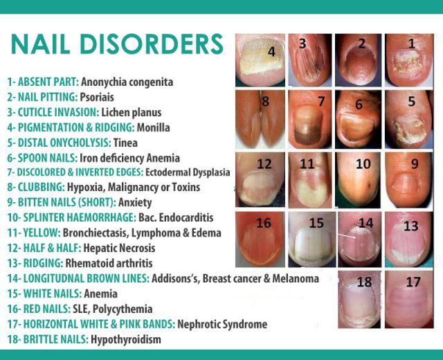 Fingernail Color And Clues To Your Health