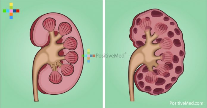 10 Signs and Symptoms of Kidney Disease, the Silent Killer, You Should ...