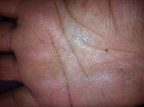 Mole on the Palm of the Hand - PositiveMed