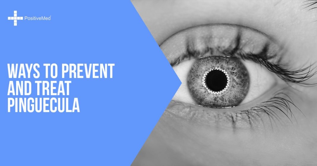 Ways to Prevent and Treat Pinguecula - PositiveMed