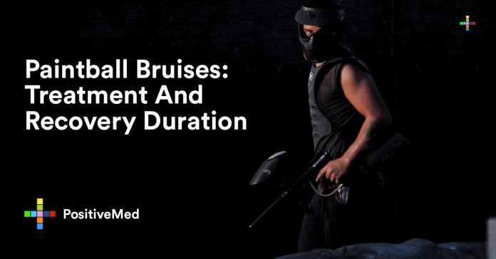 Paintball Bruises: Treatment And Recovery Duration - PositiveMed
