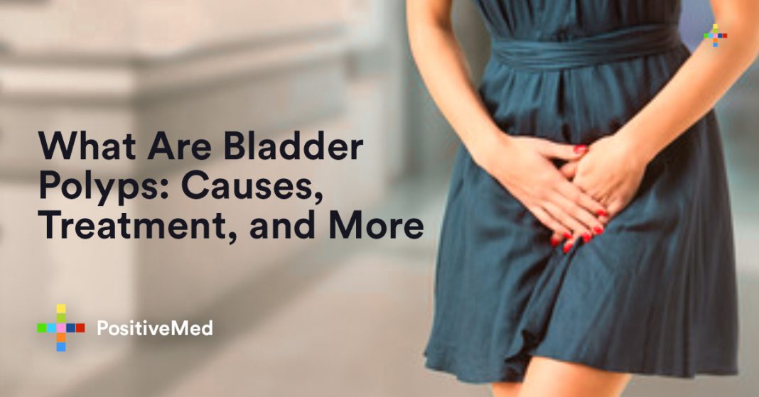 Bladder Polyps: Causes, Treatment, and More - PositiveMed