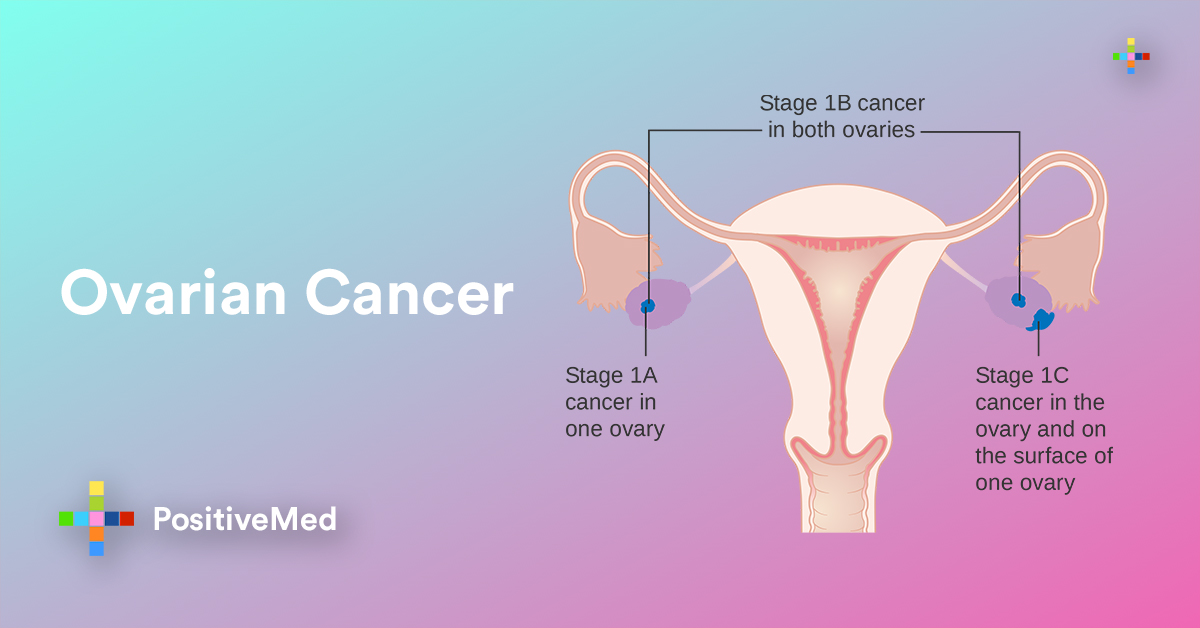 Ovarian Cancer: All You Need To Know- Symptoms and Treatments