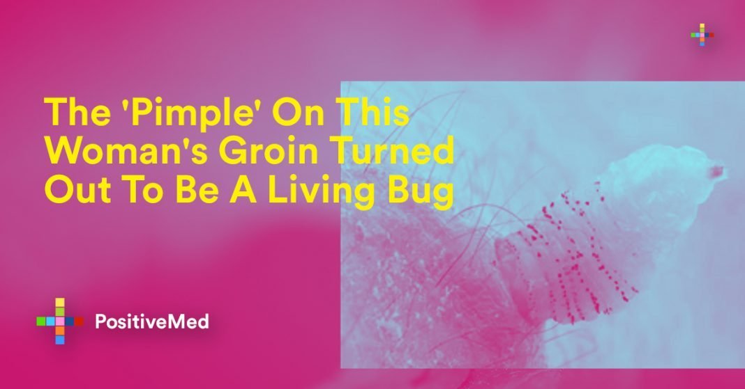 The Pimple On This Womans Groin Turned Out To Be A Living Bug