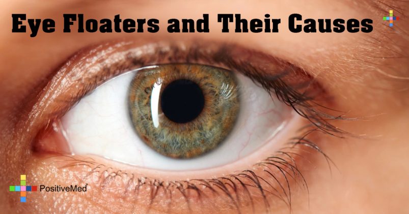 eye floaters and their causes