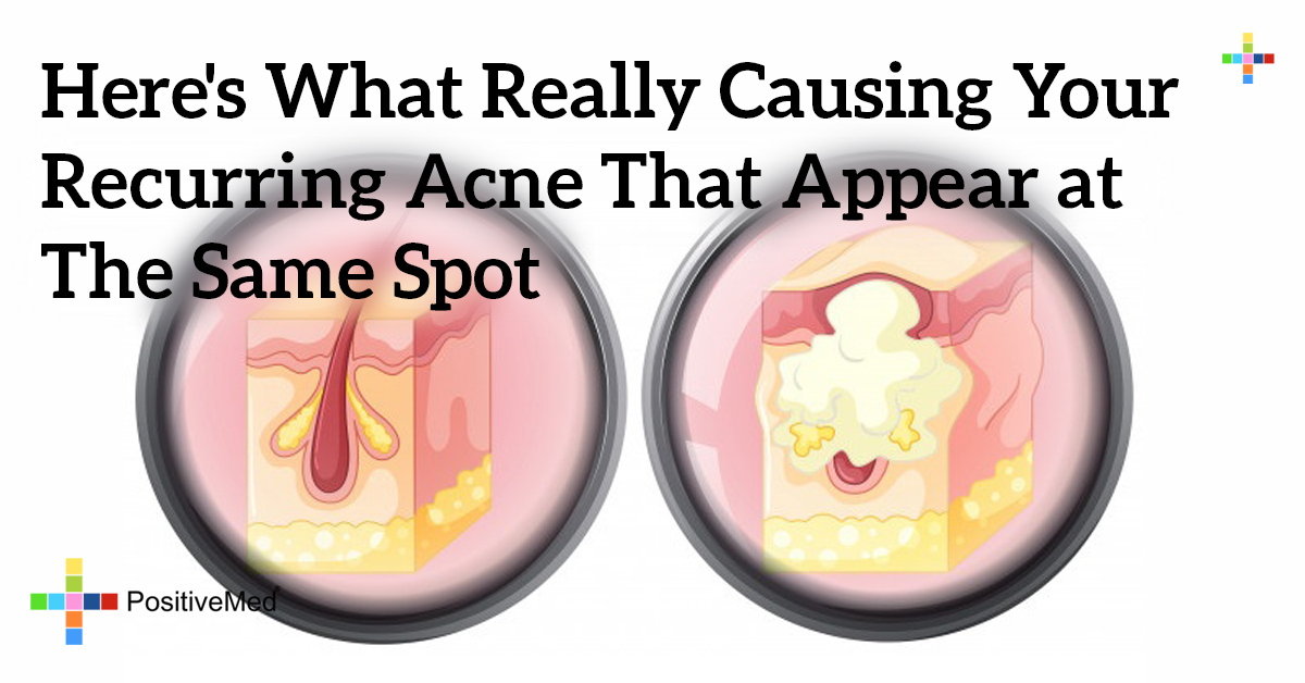 Here's What Really Causing Your Recurring Acne That Appear at The Same ...