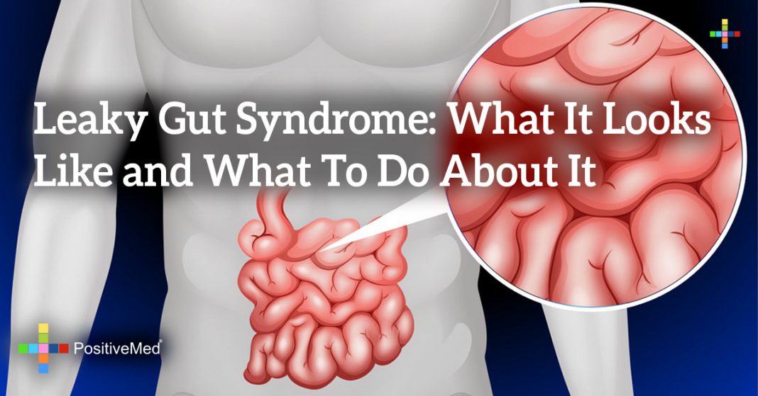 Leaky Gut Syndrome: What It Looks Like and What To Do About It