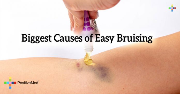 Top Reasons You Bruise Easily