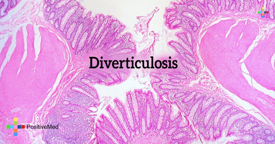 Diverticulosis