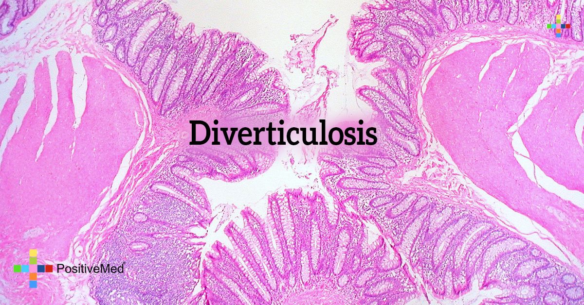 Diverticulosis