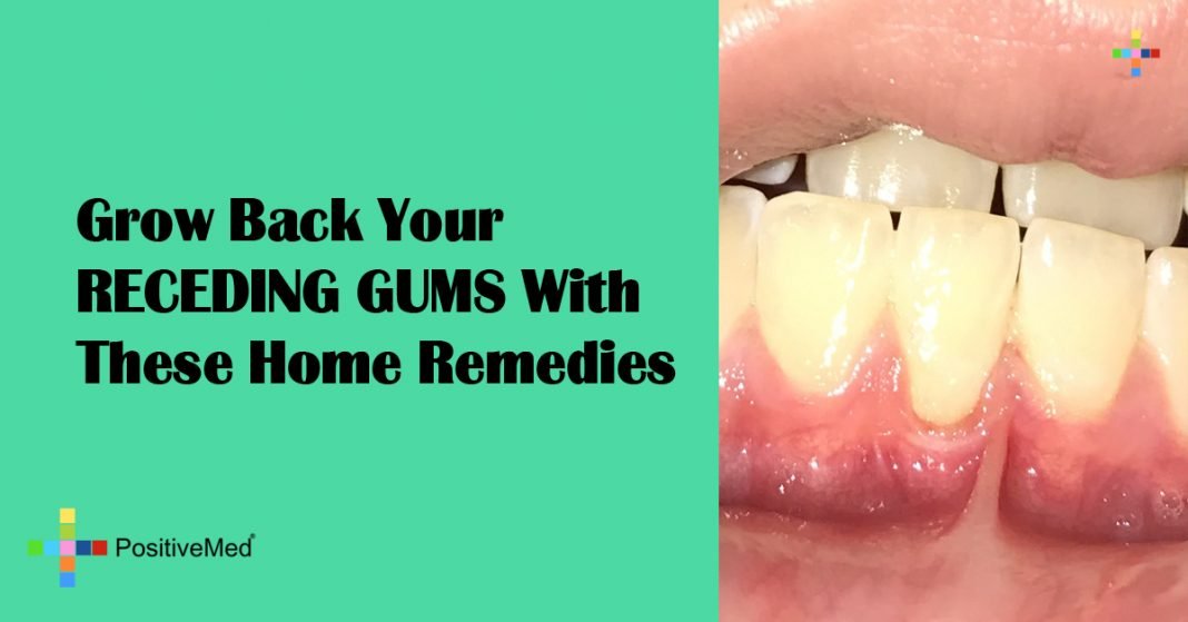 Grow Back Your Receding Gums With These Home Remedies Positivemed