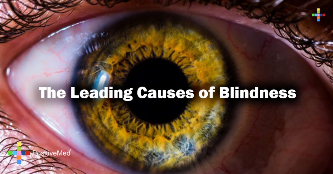 The Leading Causes of Blindness - PositiveMed