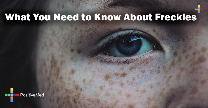 What You Need to Know About Freckles - PositiveMed