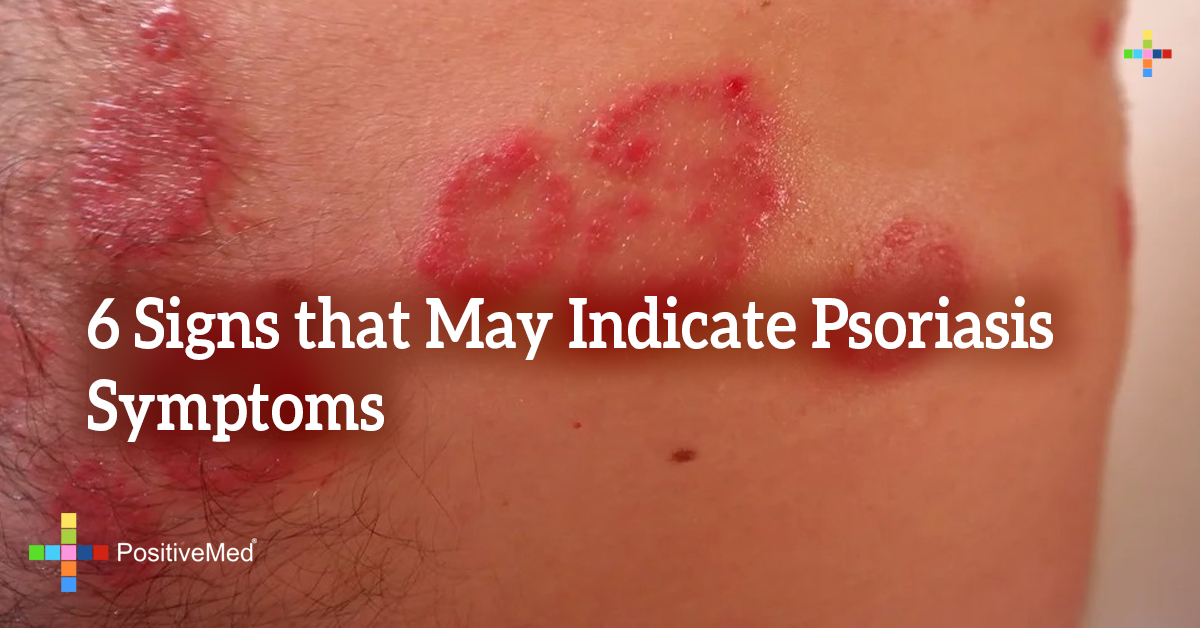 6 Signs That May Indicate Psoriasis Symptoms Positivemed