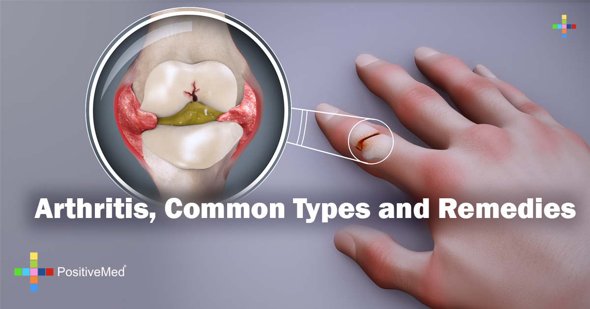 Arthritis, Common Types and Remedies