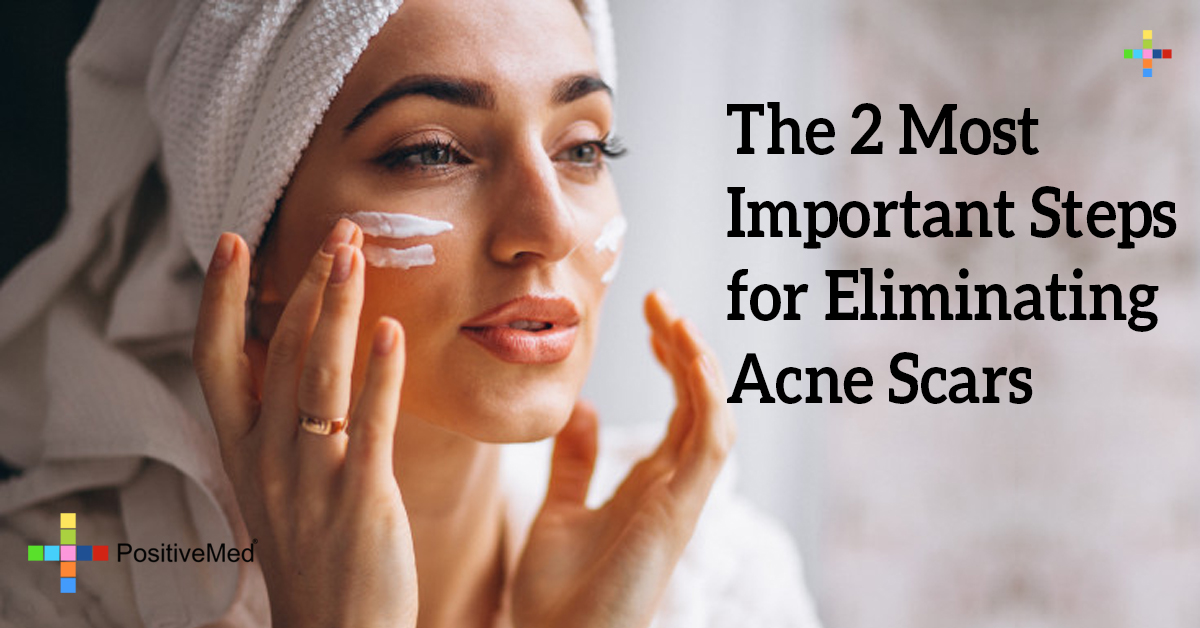 The 2 Most Important Steps for Eliminating Acne Scars