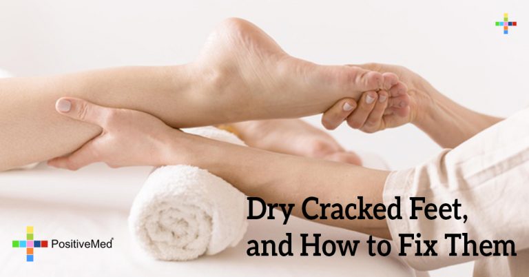 Dry Cracked Feet, and How to Fix Them