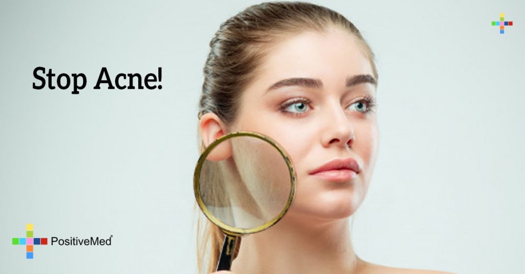 Stop Acne! - PositiveMed
