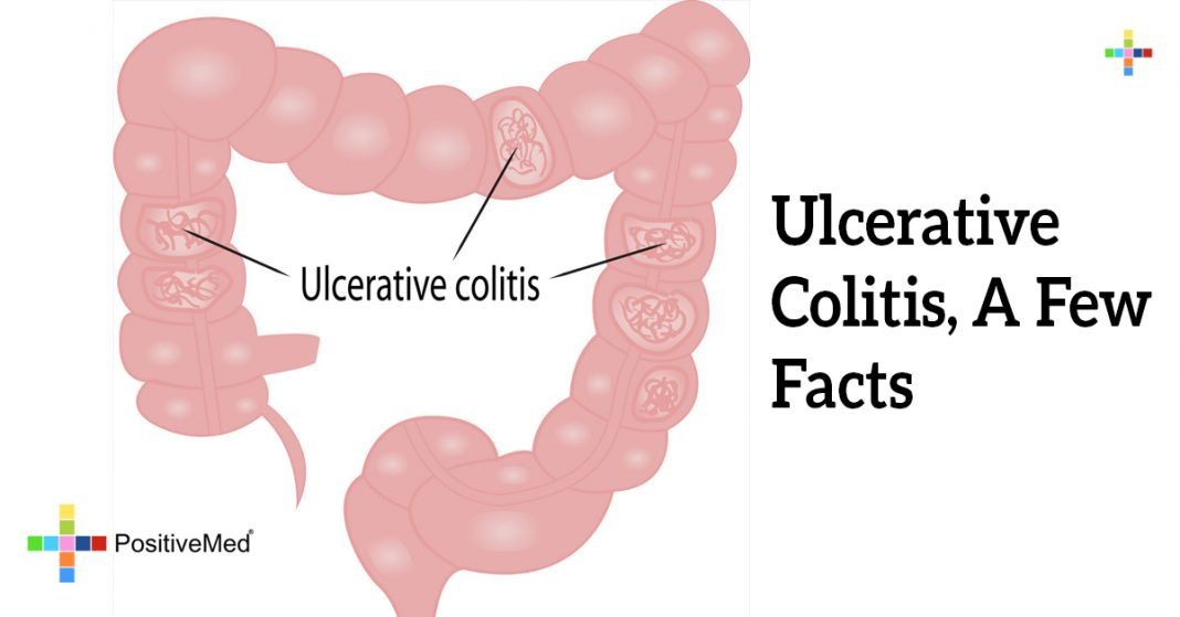 Ulcerative Colitis, A Few Facts - PositiveMed