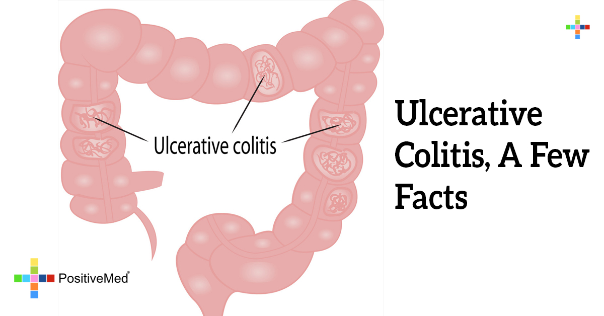 Ulcerative Colitis, A Few Facts - PositiveMed