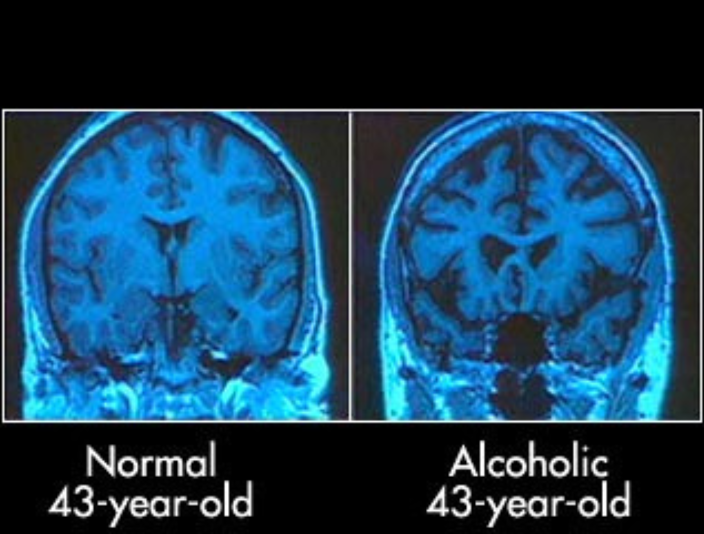 Common Brain Network Sheds Light on Substance Use Disorder