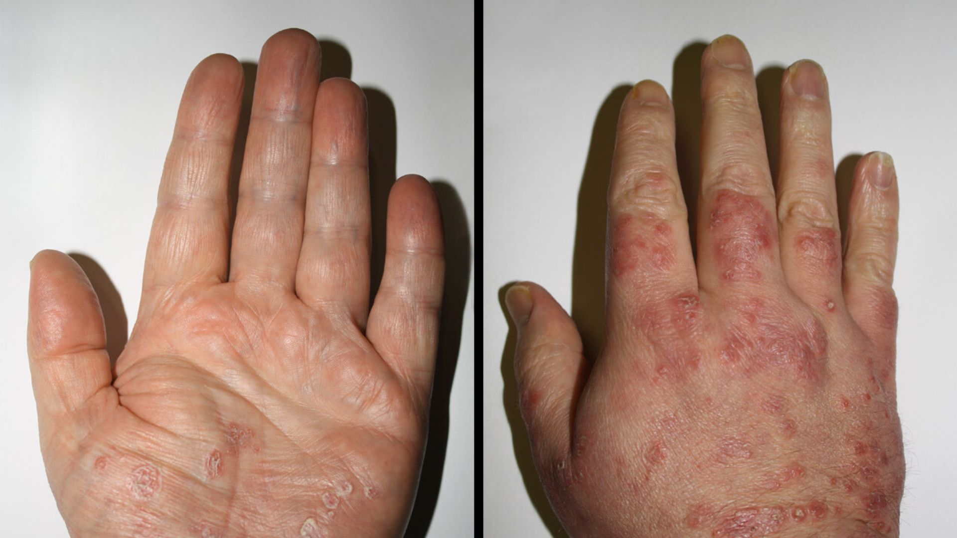 Beyond Skin: Psoriasis Unveiling Hidden Cardiovascular Risks